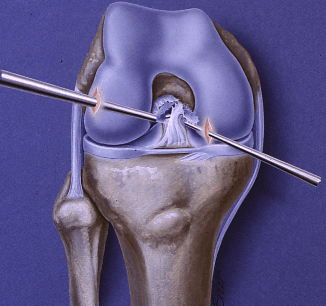 ACL SURGERY FOR RUPTURED OR TORN ACL – SYMPTOMS, SURGERY & RECOVERY OF ...