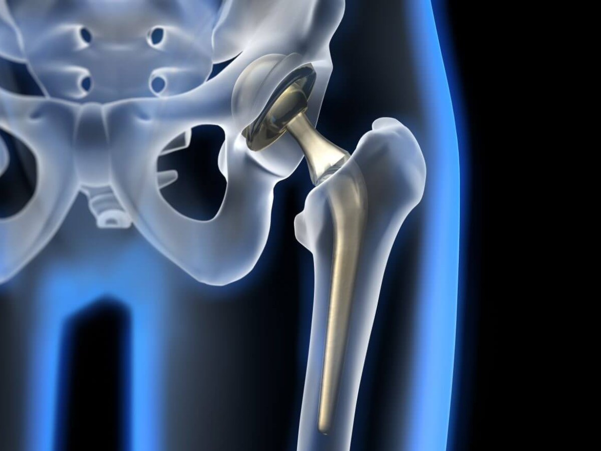 Navigating the Path to a Hip Replacement: Practical Tips and Advice ...