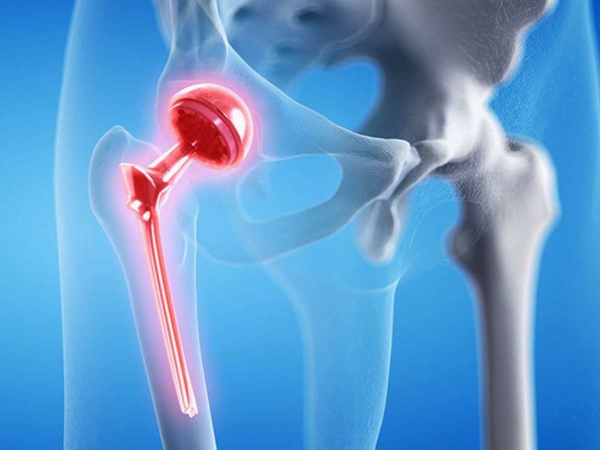 Healthy Eating After Hip Replacement Surgery: A Guide to Speeding Up ...